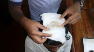 Local Pichu Treatment For Painful Joints, Ligaments And Muscles