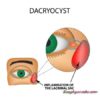 Lacrimal Cyst – Causes, Symptoms, Complications, Prognosis, Treatment